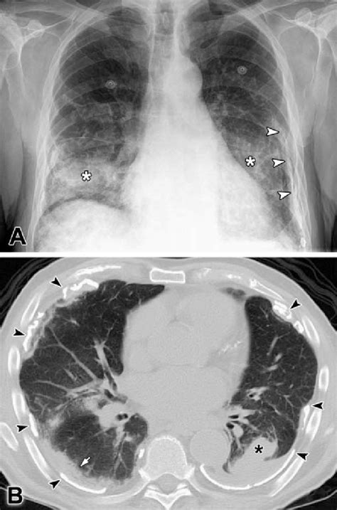 A Posterior Anterior Pa Chest Radiograph Demonstrates Extensive Download Scientific Diagram