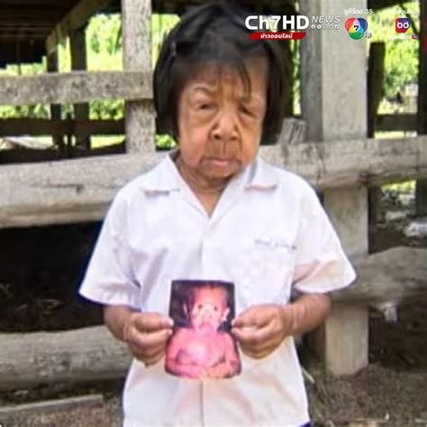 ข่าวเปิดใจ ยุพา สาววัย 29 ที่เป็นโรคหน้าแก่ตั้งแต่กำเนิด ชีวิตเหมือนต้องคำสาป