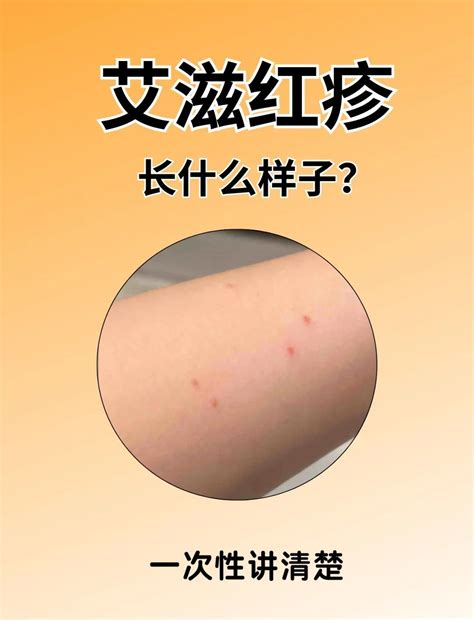 🔍艾滋红疹大揭秘！