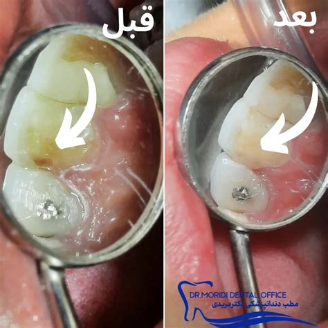پوسیدگی‌های بین دندانی و پشت دندان اغلب بدون علائمِ قابل مشاهده شروع می
