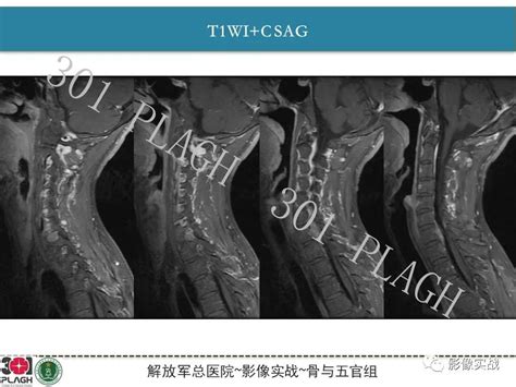 病例颈椎脊索瘤1例MR影像 影像PPT
