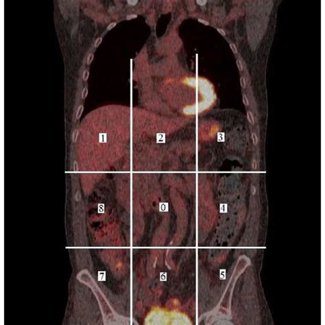 Simplified PCI Used For Scoring The Radiological PCI Download Scientific Diagram