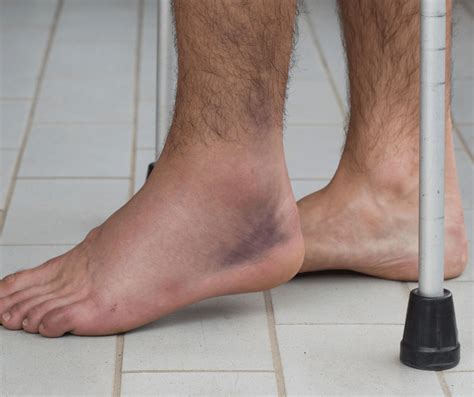 Stepping Forward With Your Ankle Sprain