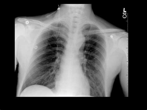 Lines Tubes And Icu Cxr Smith Ppt