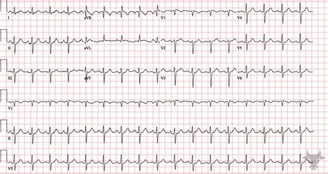 Left Anterior Fascicular Block ECG Stampede