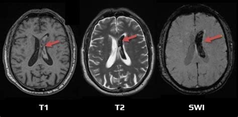 Intraventricular Hemorrhage In Adults Stroke Manual