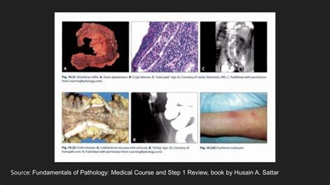 Difference Between Crohns Disease And Ulcerative Colitis Pptx