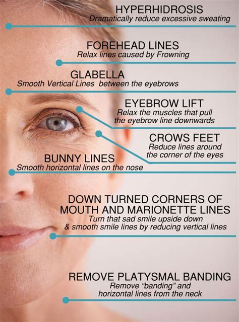 Image Result For Botox Injection Sites Diagram Botox Injection Sites