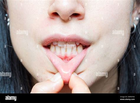 Condition Of Gum Recession Where The Margin Of The Gum Tissue