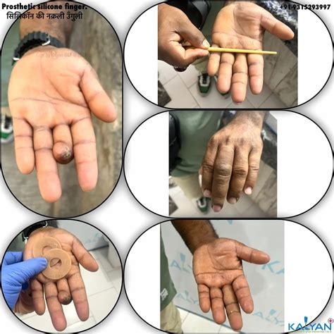 Silicone Prosthetic Finger At ₹ 16500piece Artificial Fingers In New Delhi Id 2854168028848