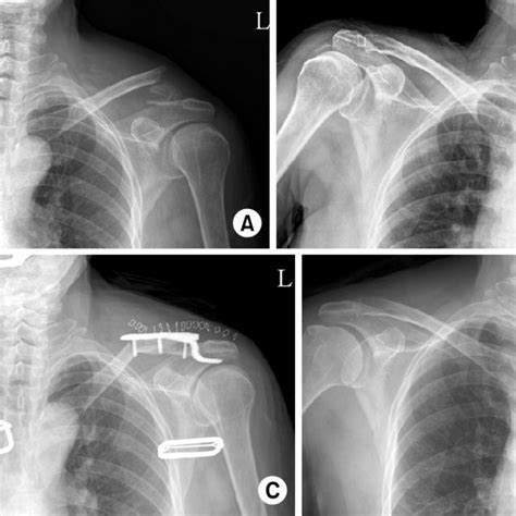 Pdf Complications Of Hook Plate Fixation For Distal Clavicle Fractures