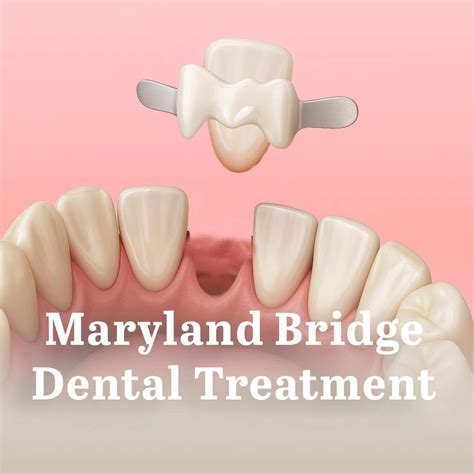 Maryland Bridge Dental Treatment Guide İstanbul Turkey