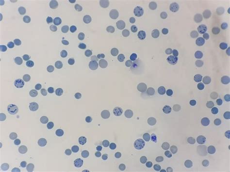 Britone Aseka On Linkedin Reticulocytes Are Immature Red Cells That Contain Residual Rna Material…