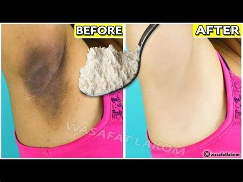 How To Remove Dark Spots Under Armpit