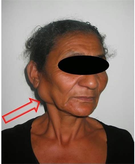 Estomatologia Online Adenoma Pleomórfico