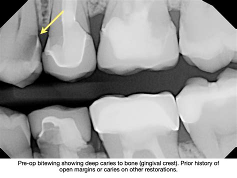 Biomimetic Restorative Bioclear Elm Endodontics And Wellness
