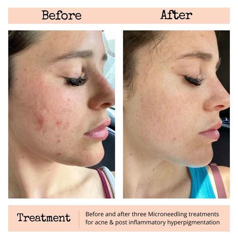 Acne Treatments In Scottsdale A Clinical Corrective Approach
