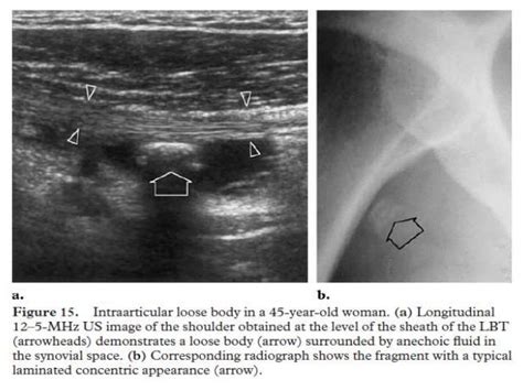 Presentation1 Pptx Ultrasound Examination Of The Shoulder Joint