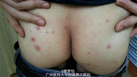 成人手足口病1例