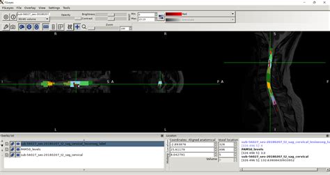 Negative Values With Sct Analyze Lesion SCT Spinalcordmri Org