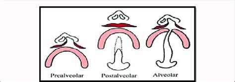 Davis And Ritchies Classification Download Scientific Diagram