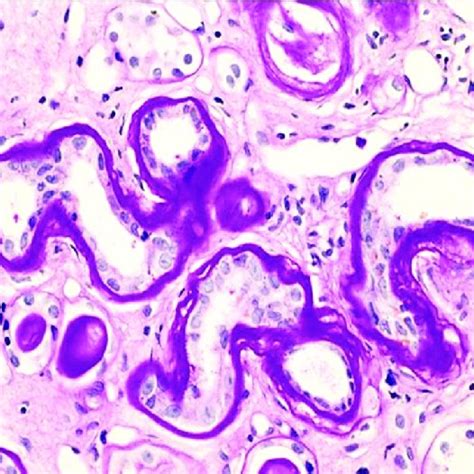 Diffuse And Nodular Diabetic Glomerulosclerosis Periodic Acid Schiff Download Scientific