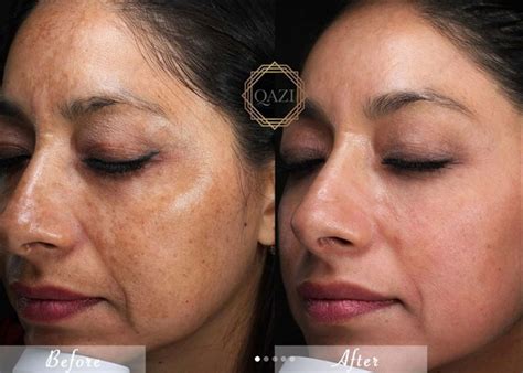 Everything You Need To Know About Hyperpigmentation