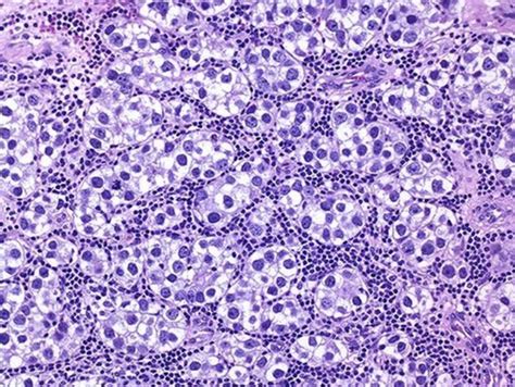 Pathology Of Male Reproductive System Flashcards Quizlet
