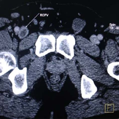 Fluoroscopic Image Showing Gunther Tulip Filter After Its Placement In