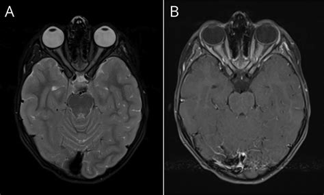 Teaching Neuroimages Bilateral Optic Neuritis Neurology