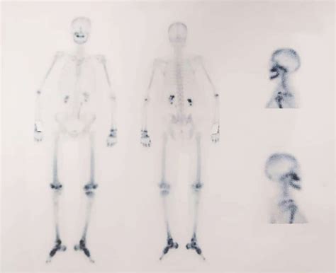 Whole Body Bone Scan Revealing Symmetrical And Diffused Increased