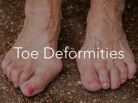 Toe Deformities Carrollton Foot Center
