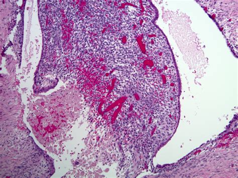 Catamenial Pneumothorax What Is This Finding Kiko Xp