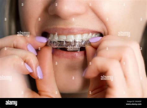 Woman Inserting Transparent Invisible Dental Aligners For Teeth Straightening Stock Photo Alamy