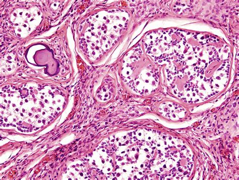 Containing Both Germ Cell And Sex Cord Stromal Elements Abdominal Key