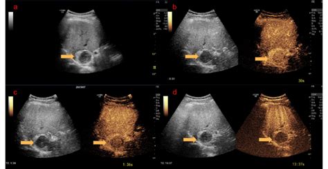 A Liver Mass Discovered During Physical Examination In A 30 Year Old Download Scientific