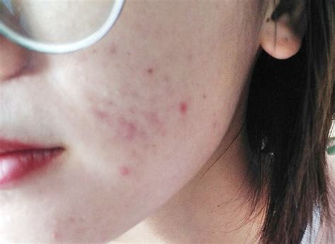 하이드로퀴논 연고 4 기미 여드름 제거 과정 네이버 블로그