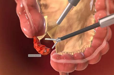 Appendix Treatment Saru Hospital