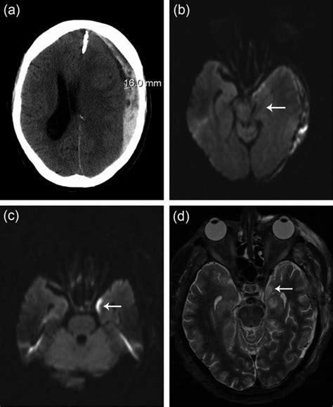 Computed Tomography Of Subdural Hematoma And Cerebral Magnetic
