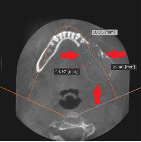 Marsupialization Of A Large Dentigerous Cyst In The Mandible A Case Report Pmc