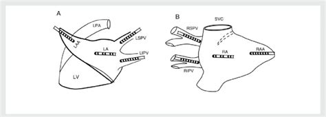Schematic Representation And Catheter Positions In The Atria And