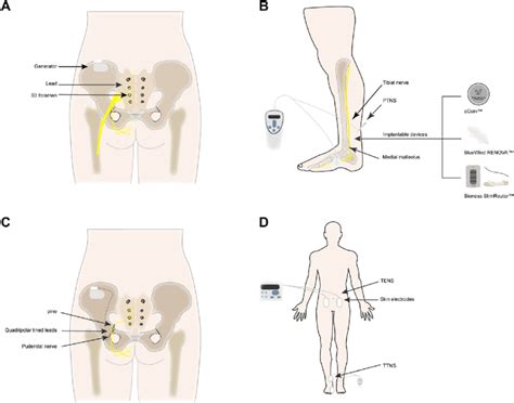 Stimulation Sites Of Various Types Of Neuromodulations A Sacral Download Scientific Diagram