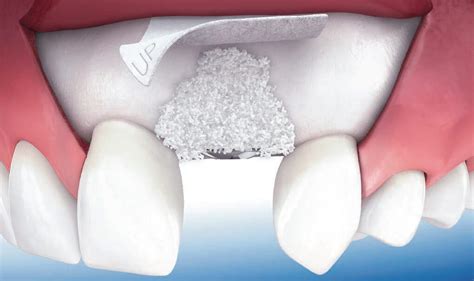 Exposed Membrane Bone Graft At Mitchell Cushing Blog