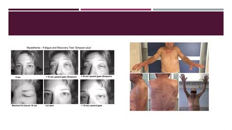 Neuromuscular Junction Pptx