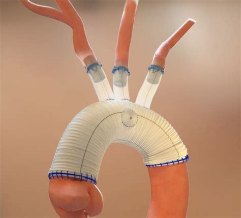 Cci创新快讯｜ Aquedeon Medical Duett 血管移植系统获得 Fda 批准duettccifda主动脉移植物血管心胸 健康界