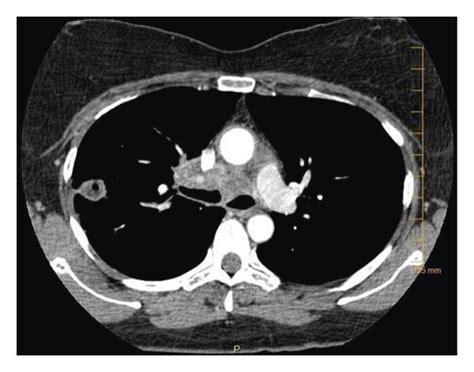 Ct Chest Showing Large Necrotic Mass Download Scientific Diagram