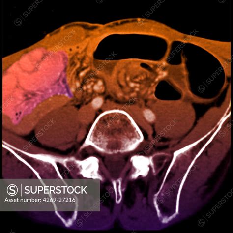 Intestinal Obstruction Colored Enhanced Axial Computed Tomography Ct