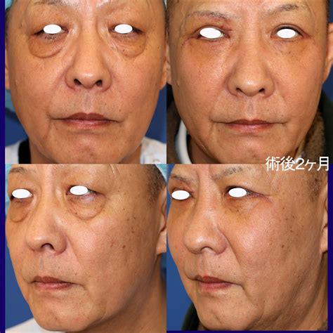 頬部骨膜下リフトによる下眼瞼除皺術。術後2ヶ月 株式会社形成技研 形成外科医 美容外科医 田中哲一郎のブログ
