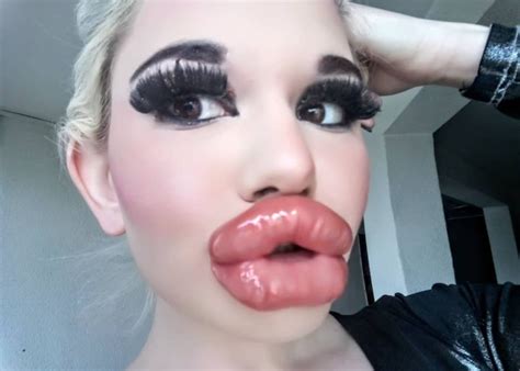 Andrea Ivanova Goes Viral After Getting 20 Lip Injections — Real Life