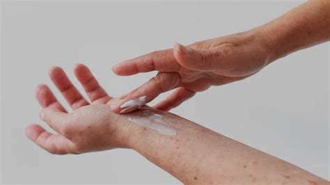 हथेलियों पर रैशेज के कारण और इलाज का तरीका Palm Rash Causes And